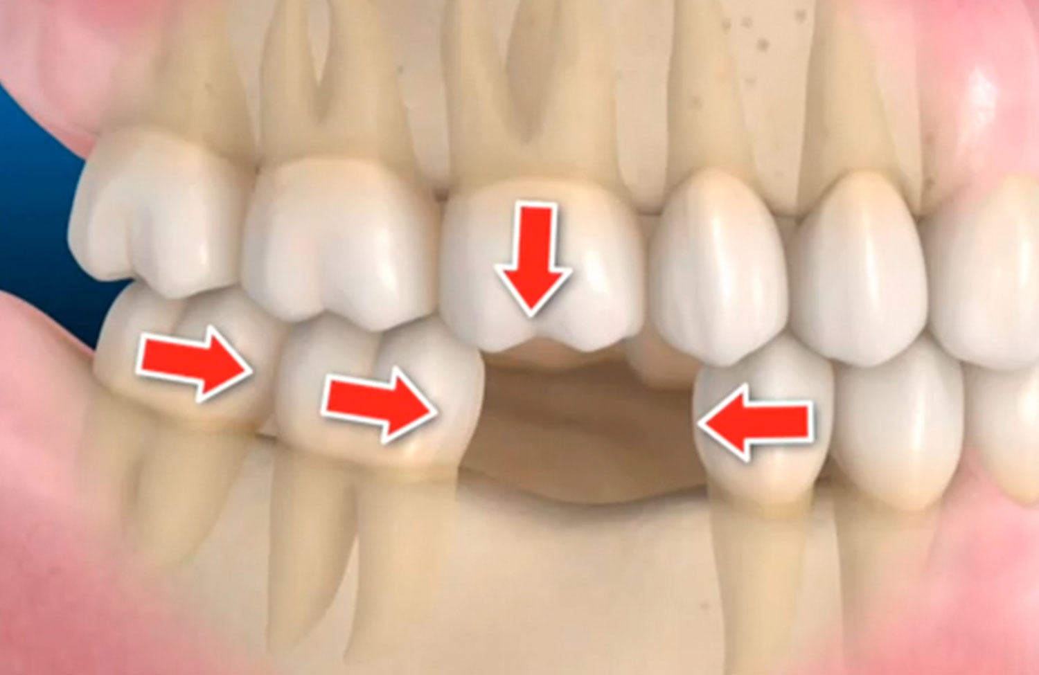 ¿Qué consecuencias puede tener la pérdida de un diente?